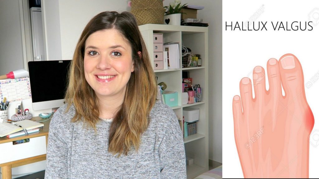 Mon opération du pied : 3 ans après (hallux valgus & rigidus) - Le Blog ...